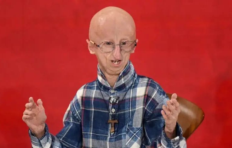 Fallece Sammy Basso, el paciente con progeria más longevo del mundo ...